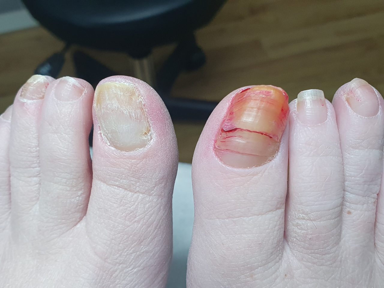 Thickened Toenail - West Berkshire Foot Clinic