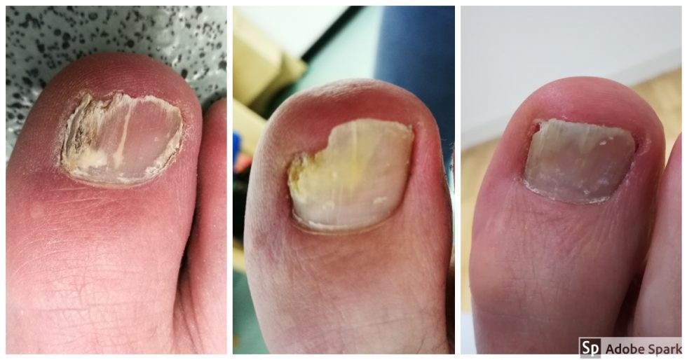Fungal Nails - Diagnosis and Treatment - West Berkshire Foot Clinic